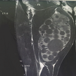 Primary hydatid cyst of the thigh: about four cases