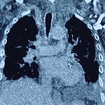 Myxœdème des voies aérodigestives supérieures associée à une embolie ...