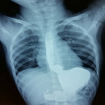 La fundoplicature laparoscopique de type Nissen pour hernie hiatale ...