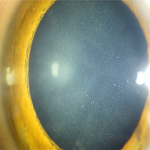 Cataracte poussiéreuse