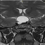 Intra-suprasellar Rathke's cleft cyst: a case report and literature review