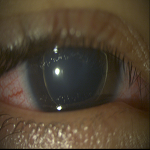 Une luxation bilatérale antérieure du cristallin révélant une ...