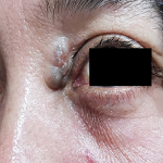 Apocrine hidrocystoma of the orbit mimicking basal cell carcinoma: a ...