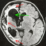 Cas rare d´un syndrome de Rasmussen dans un contexte malformatif ...