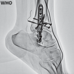 Successful endovascular limb salvage revascularization in a patient ...
