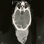 Mélanose colique: attention aux laxatifs!