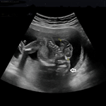 Mélanose colique: attention aux laxatifs!