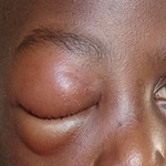 Endocranial complications following acute ethmoiditis: a case report