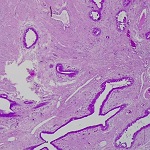 Bilateral fibroadenomas and gynecomastia in a young male: sequential or ...