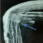 Radial head anterior dislocation and ulna bowing in children