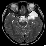 Temporal arachnoid cyst compressing the hippocampus