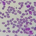 Plasmocytes en trèfle aspect rare de dystrophie plasmocytaire, révélant ...