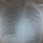 Le syndrome de Mendelson bronchique