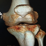 Pellegrini-Stieda syndrome