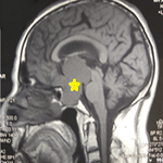 Giant pituitary macroadenoma