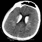 Fahr´s disease: idiopathic abnormal basal ganglia calcifications in the ...