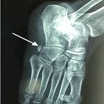 Peroneum bone but not a cuboid fracture