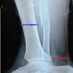 A particular ankle fracture: destot fracture with a fibular shaft fracture