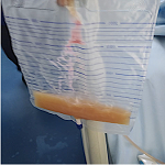 Pink urine syndrome (pus): a case report
