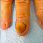 Monstrous glomus tumor of nail bed clinical and dermoscopic appearance ...