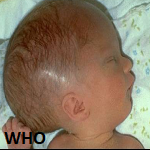 Radiological aspect of hydranencephaly: a case report