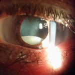 Luxation postérieure bilatérale spontanée du cristallin