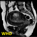 Uterine smooth muscle tumors of uncertain malignant potential (STUMP ...