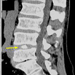 Lumbar intervertebral disc calcification in adult