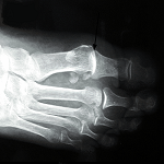 First metatarsophalangeal joint dislocation: uncommon affection