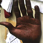 Reversible hyperpigmentation in Vitamin B12 deficiency: an Addisonian ...