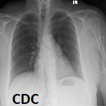 BRASH syndrome: an emerging emergency