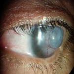 Ectasie cornéenne post-infectieuse