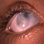 Sclérocornée congénitale bilatérale associée à un syndrome polymal formatif