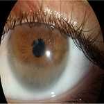 Corneal band keratopathy