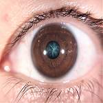 A typical combination of a Y-suture and cerulean cataract