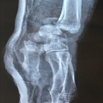 Luxation radio-carpienne