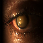 Haematocornea: a turning point in neglected trauma!