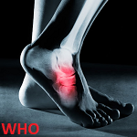 Imagerie d´un os naviculaire accessoire symptomatique