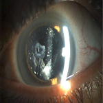 Post traumatic regressive cataract