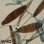 Exserohilum rostratum keratitis: report of a case from South Africa