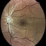 Acute posterior vitreous detachment following a benign trauma