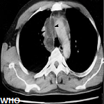 Kyste hydatique sous-cutané solitaire de la région fessière: cas clinique