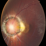 A case of morning glory syndrome