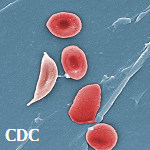 Complications aiguës de la drépanocytose en réanimation: étude ...