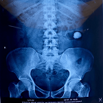 Case of congenital ureteropelvic junction obstructive nephrolithiasis ...