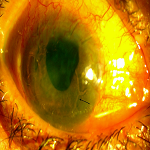 Spontaneous lens luxation into anterior chamber: why is it important to ...